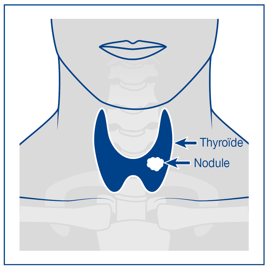 Haute Autorité de Santé - Nodule de la thyroïde - Comment l'explorer
